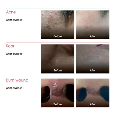 EXOXE Face 50 mg + 5 ml - Premium Dermal Filler